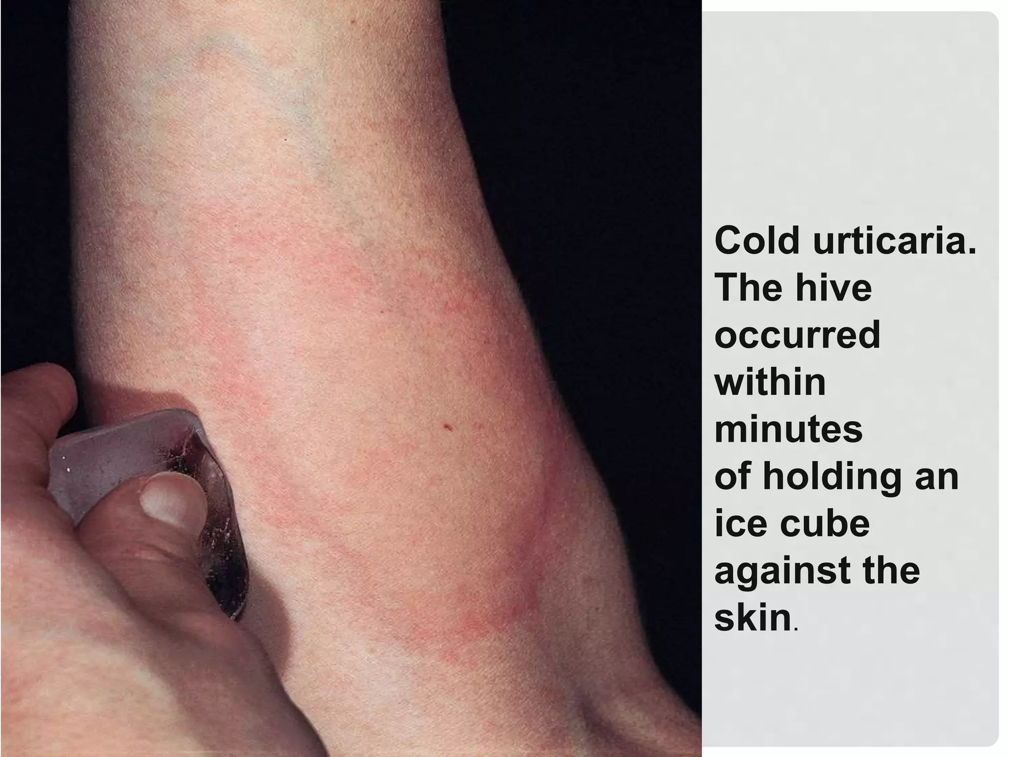 urticaria .pptx