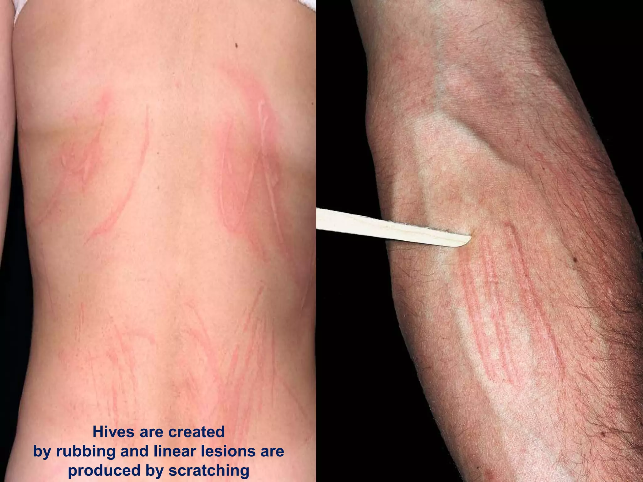 urticaria .pptx