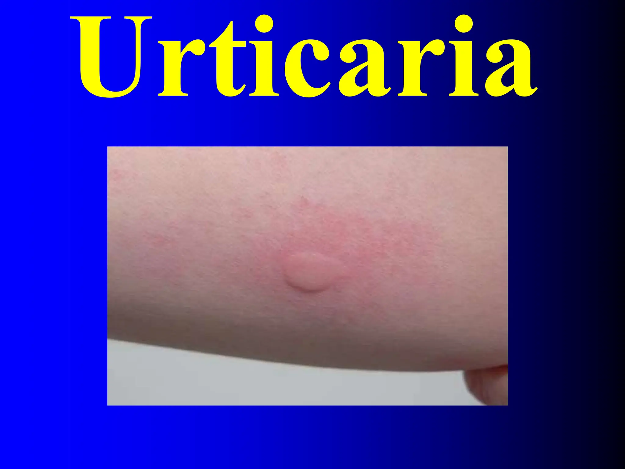 urticaria.ppt Dermatology Skin conditions Allergy | PPT