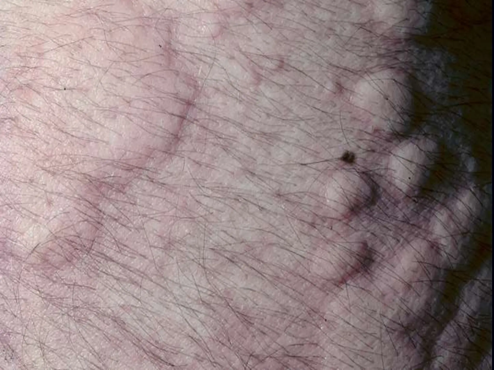 urticaria.ppt Dermatology Skin conditions Allergy | PPT