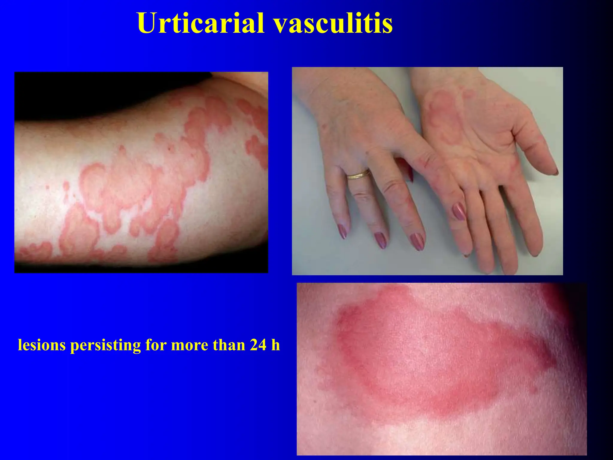 urticaria.ppt Dermatology Skin conditions Allergy | PPT