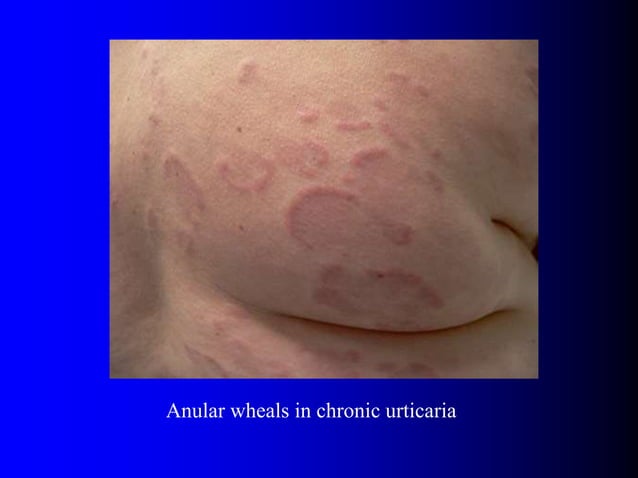 urticaria.ppt Dermatology Skin conditions Allergy | PPT