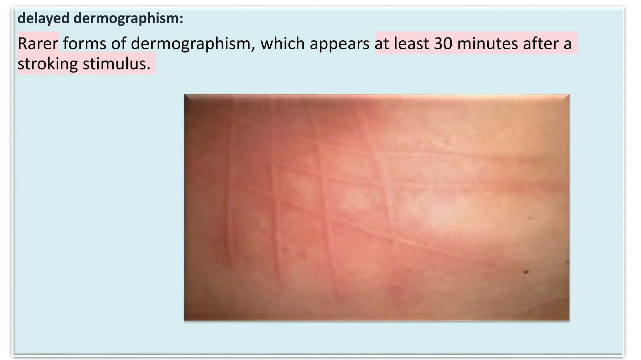 Urticaria ,types and management bolognia .pptx