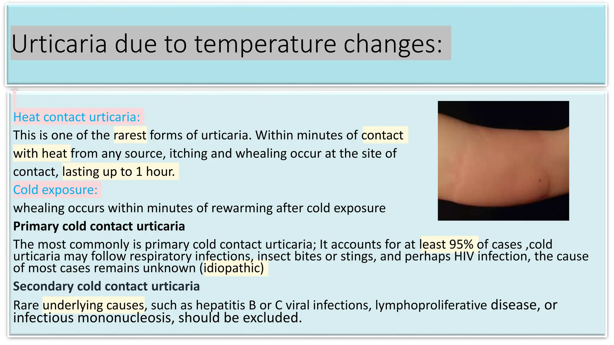 Urticaria ,types and management bolognia .pptx