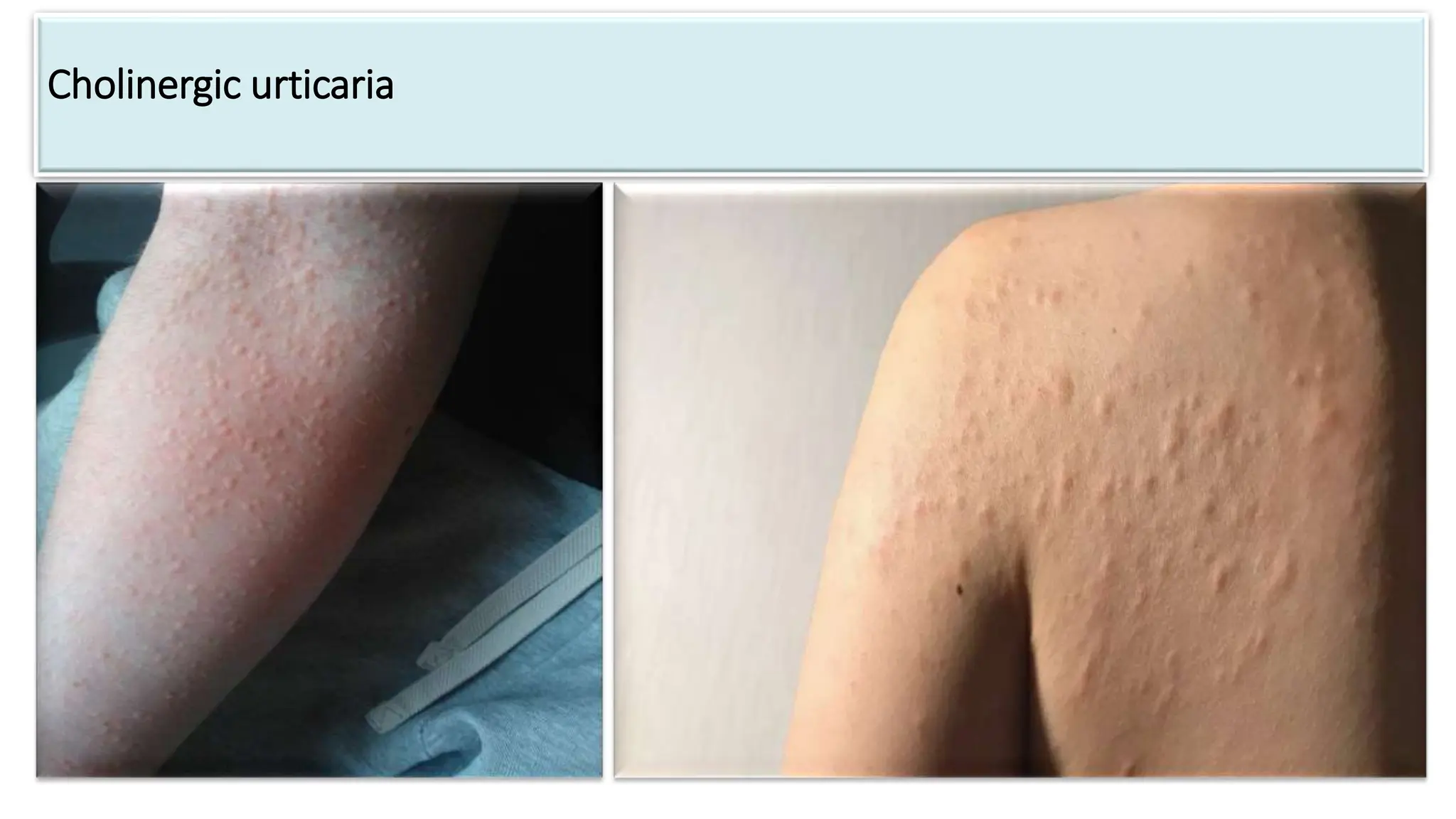 Urticaria ,types and management bolognia .pptx