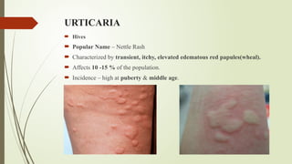 A Brief note on Urticaria by Srivastavaa | PPTX