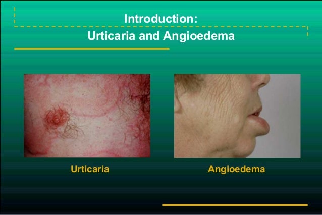 Urticaria&angioedema(copiedsenior)