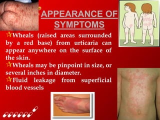 URTICARIA AND CONTACT DERMATITS-MEDICAL-BIOMEDICAL-MATHANKUMAR S | PPT