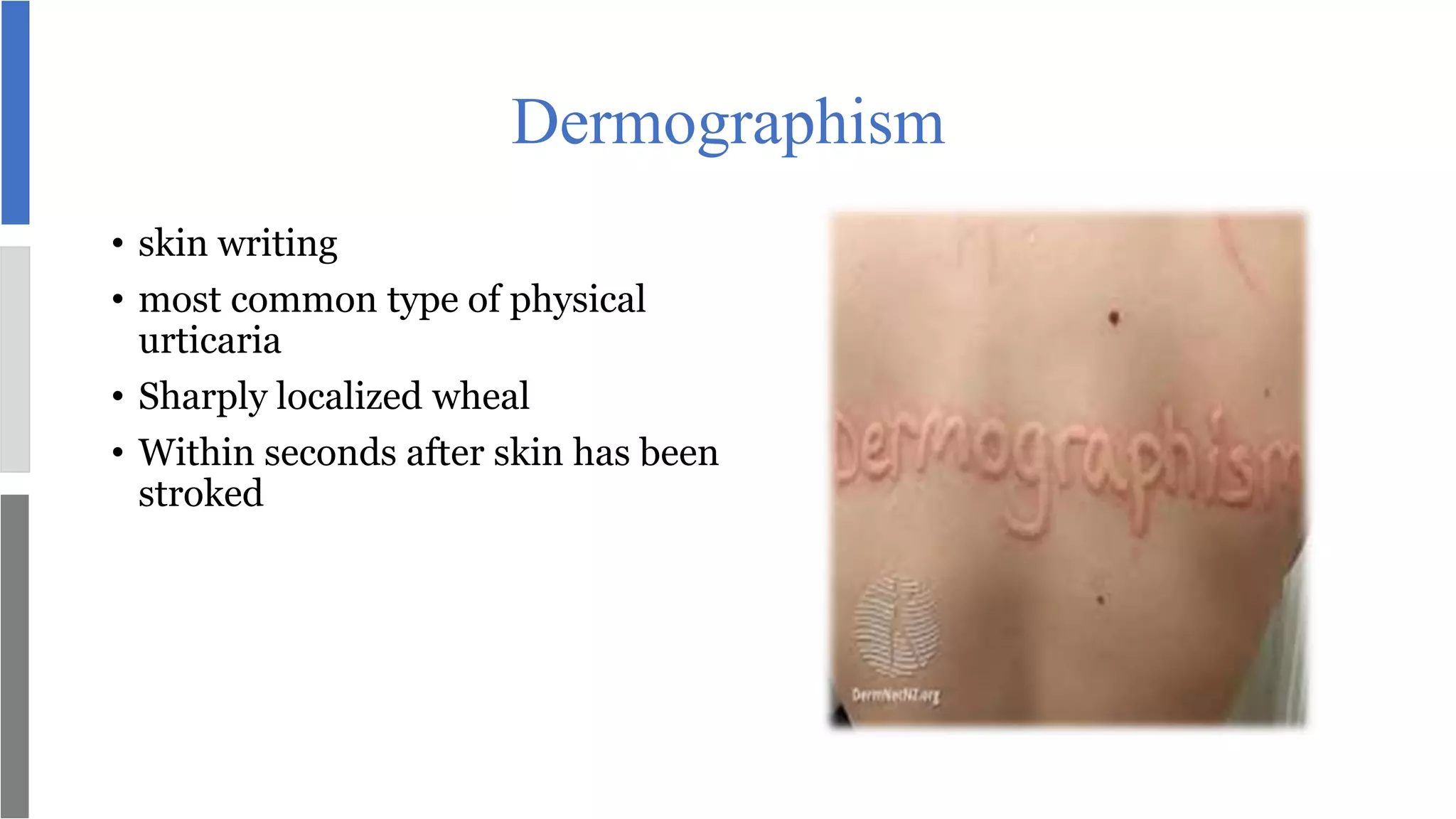 urticaria and skin allergy tests.pptx
