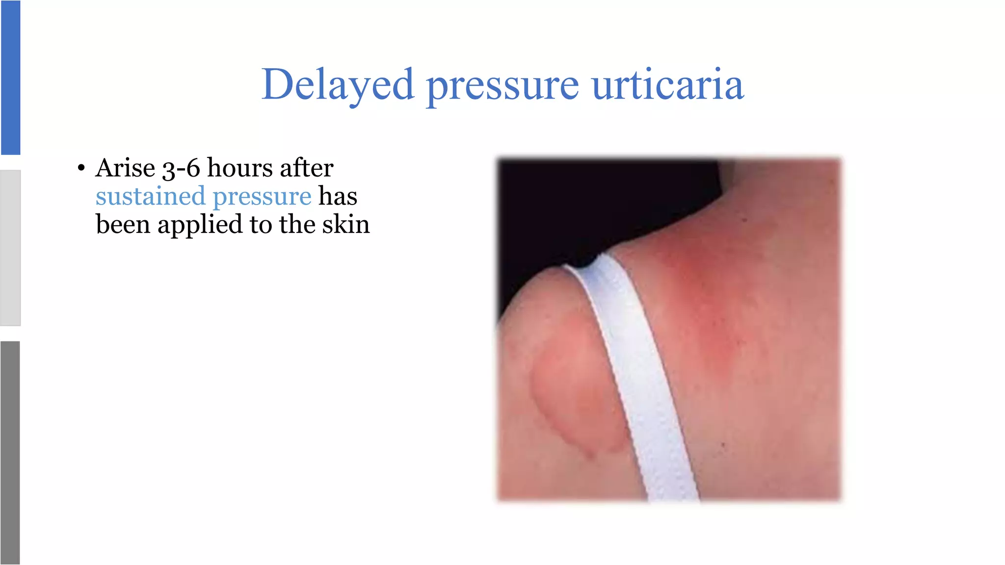 urticaria and skin allergy tests.pptx