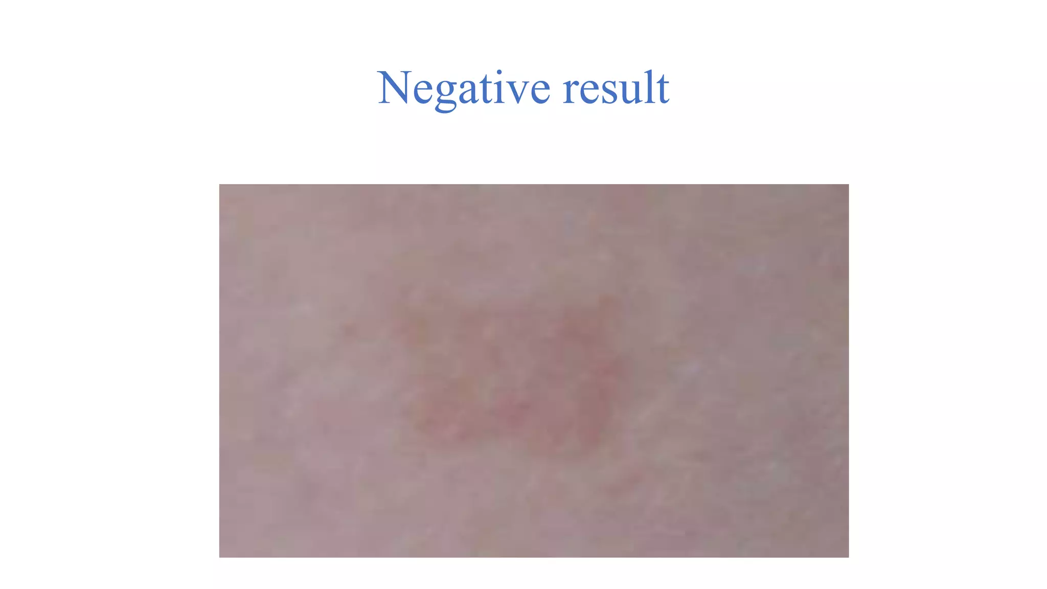 urticaria and skin allergy tests.pptx