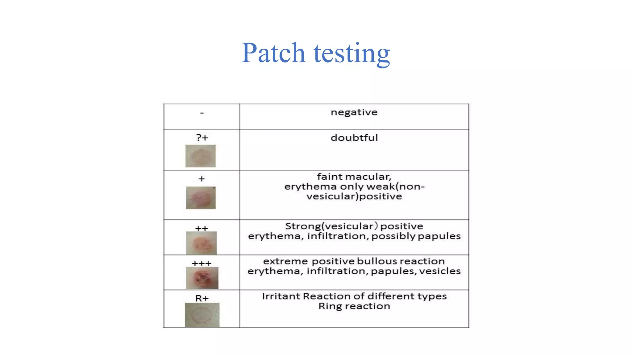 urticaria and skin allergy tests.pptx