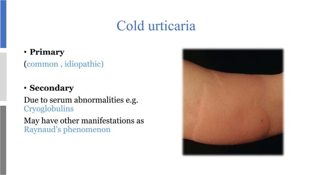 urticaria and skin allergy tests.pptx