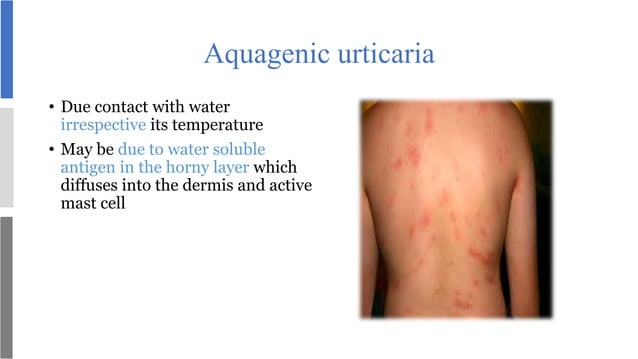 urticaria and skin allergy tests.pptx