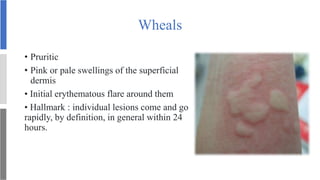 urticaria and skin allergy tests.pptx