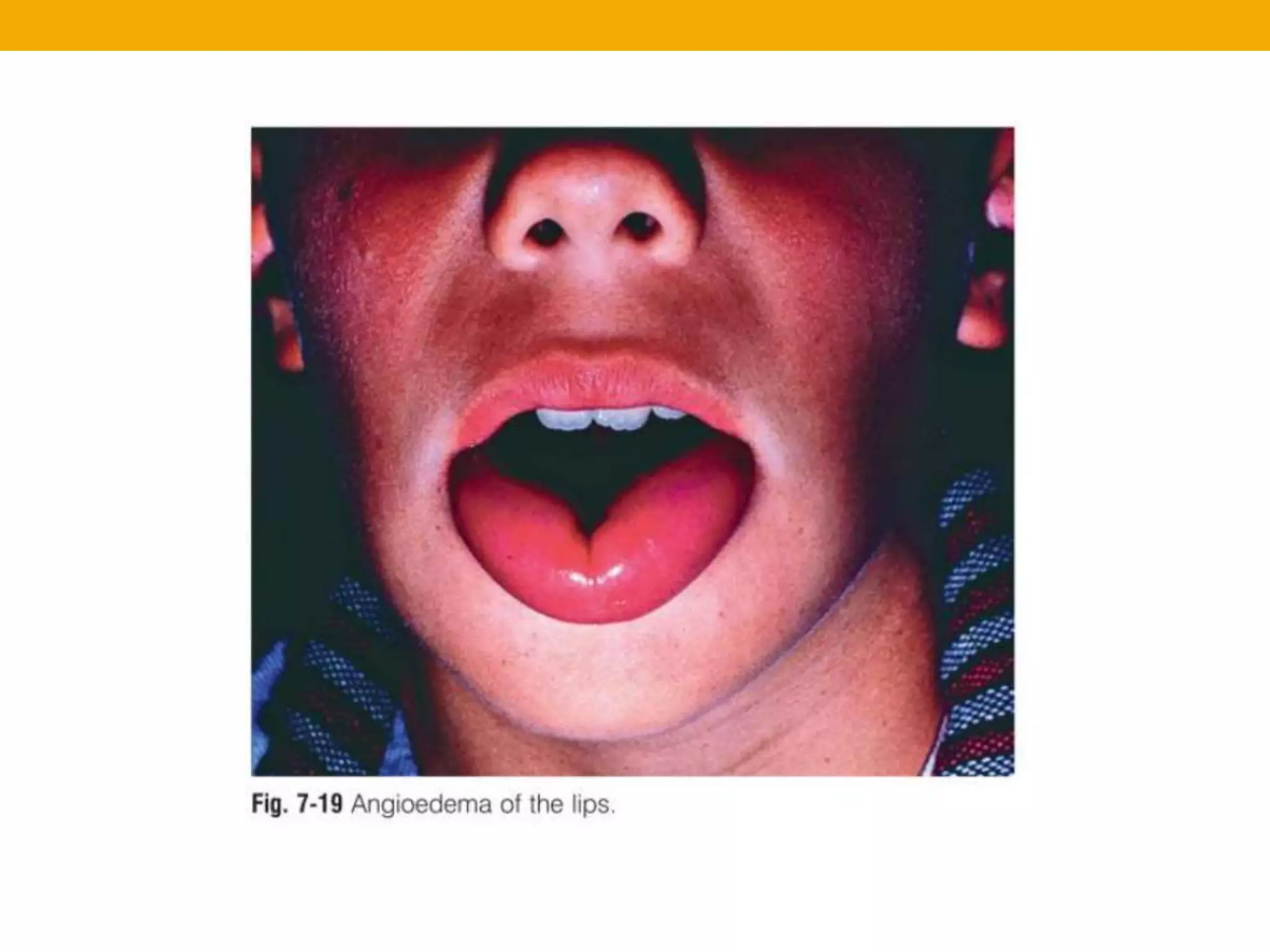 Urticaria, Angioedema, and Anaphylaxis.pptx