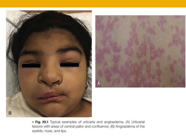 Urticaria, Angioedema, and Anaphylaxis.pptx