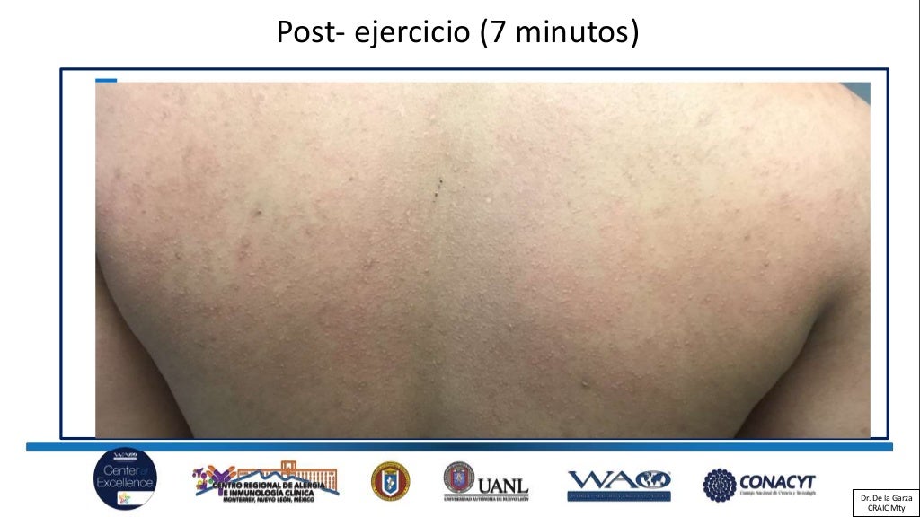 Sesión de Caso Clínico "Urticaria colinérgica
