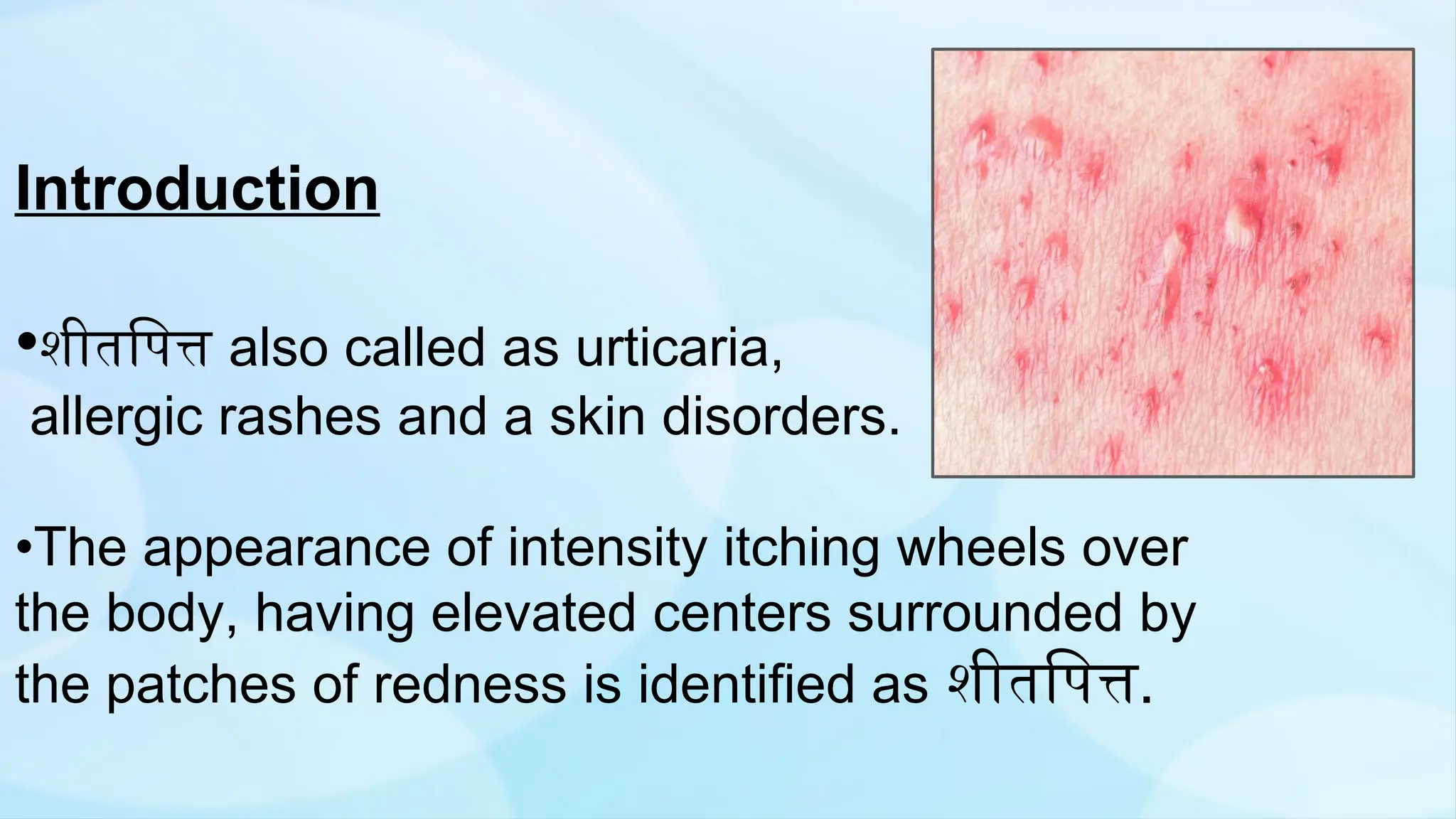 शीतपित्त (URTICARIA)final.pptxudardakotha | PPTX