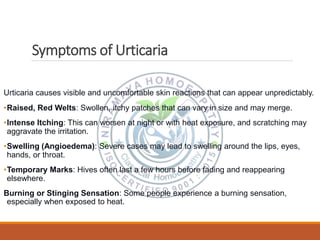 Urticaria_Hives_Causes, Symptoms & Homeopathic Treatment. | PPT