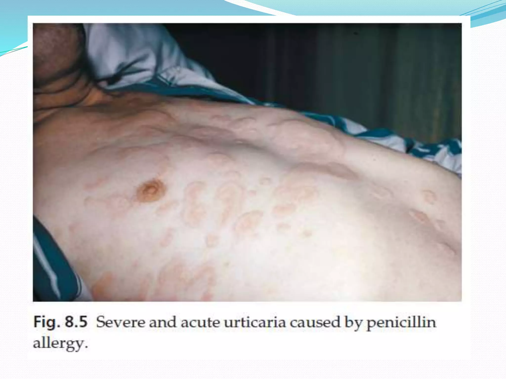 Urticaria (hives, ‘nettle rash’) | PPTX