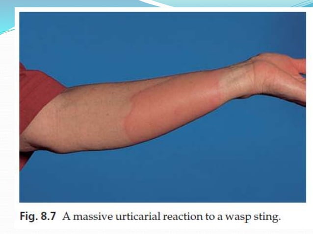 Urticaria (hives, ‘nettle rash’) | PPTX