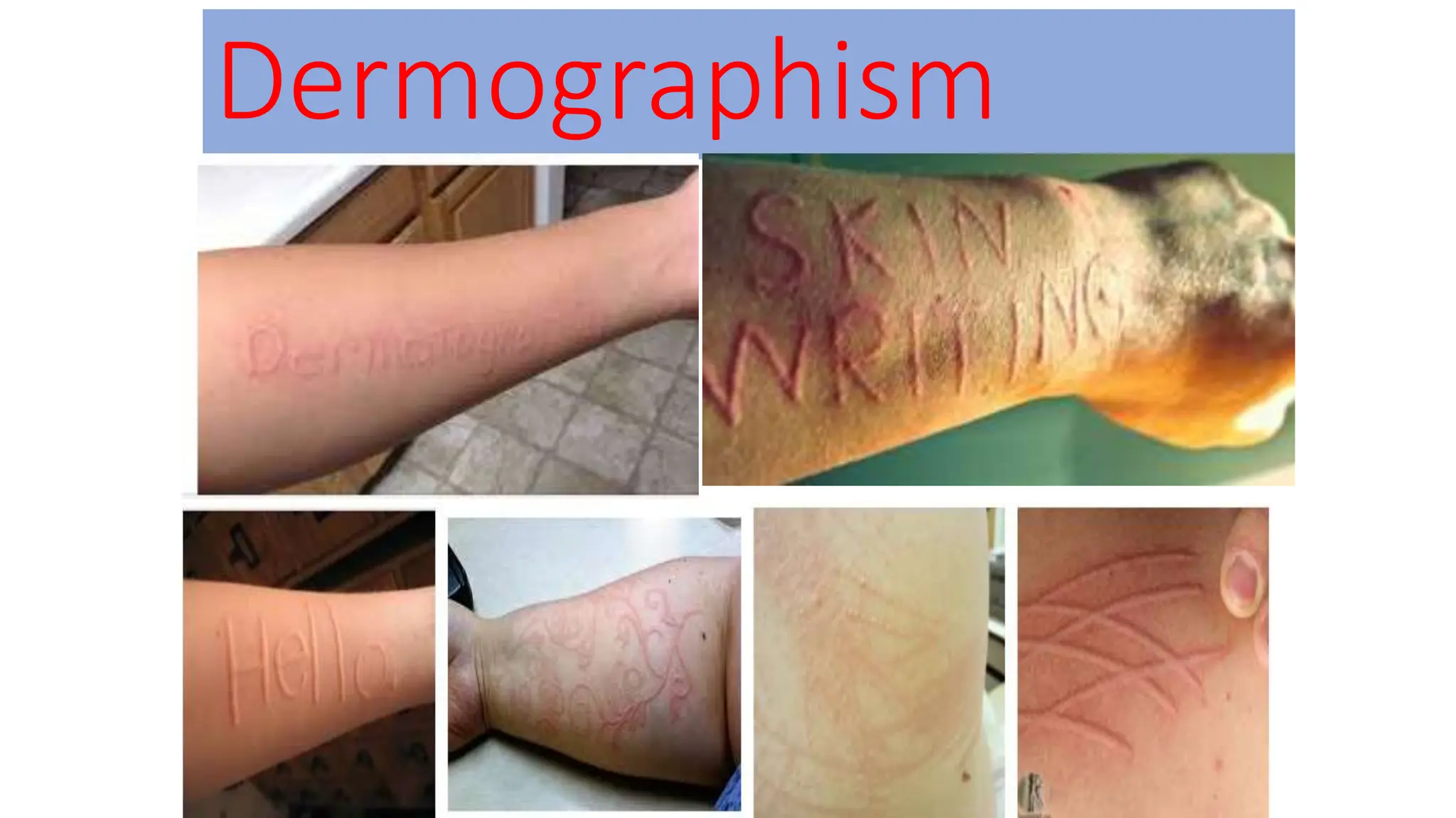 Urticarial vasculitis diagnostic challenge in 2 cases Ahmed Yehia, MD ...