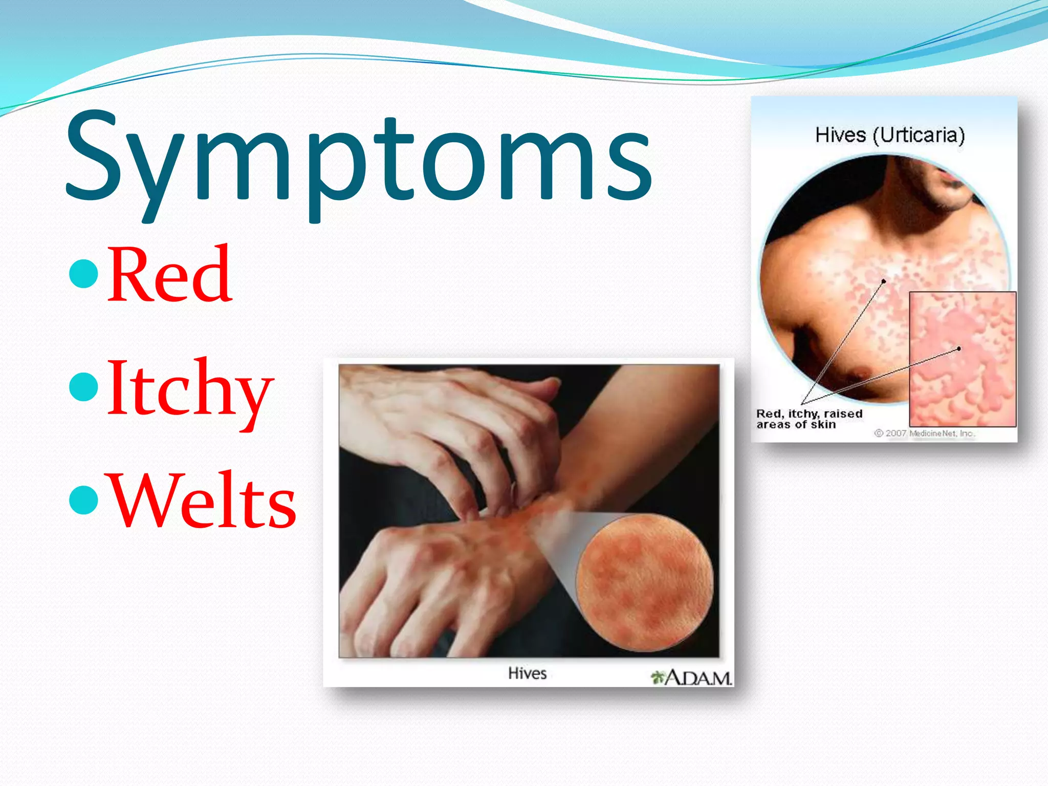 Urticaria | PPTX | Allergies | Diseases and Conditions