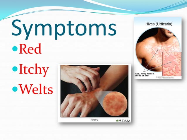 Urticaria | PPTX | Allergies | Diseases and Conditions