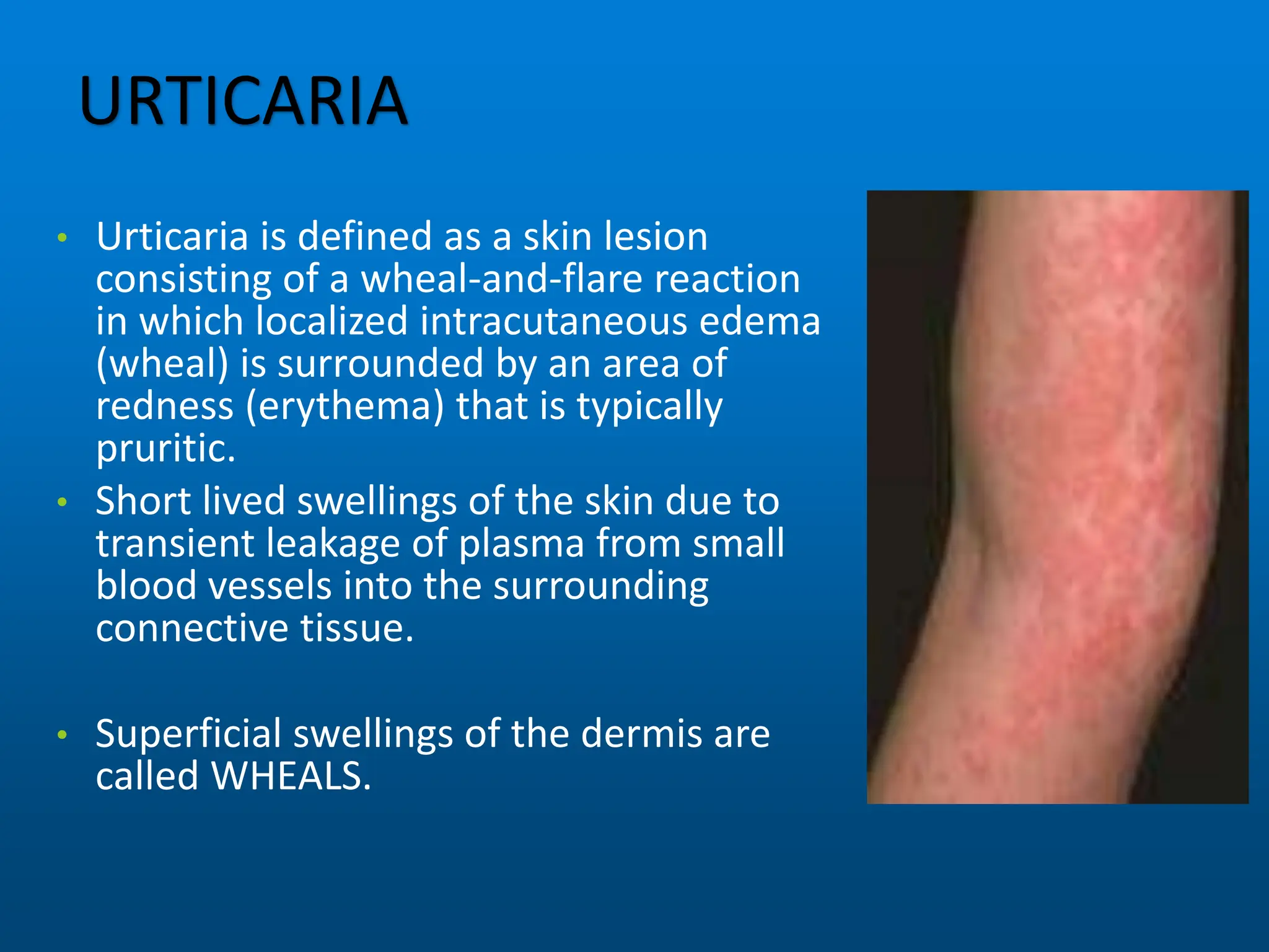 urticaria skin disease dermatology ppt.pptx
