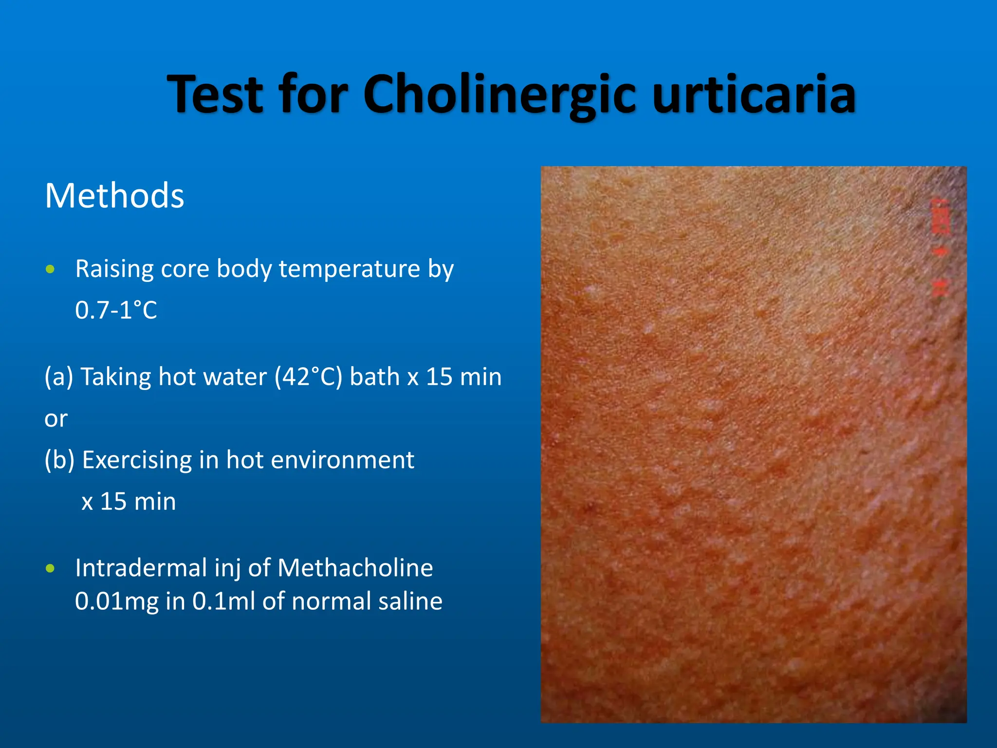 urticaria skin disease dermatology ppt.pptx