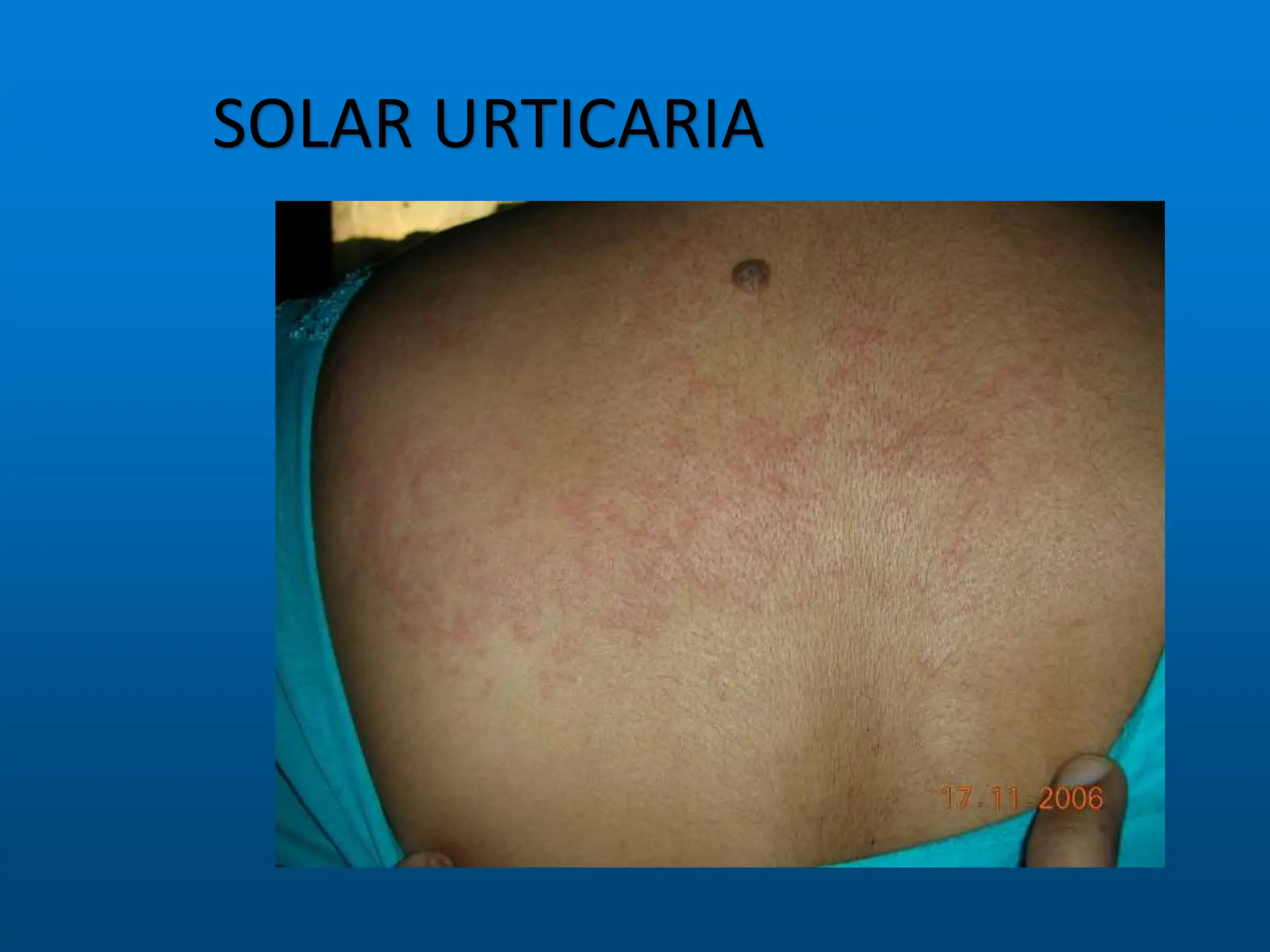 urticaria skin disease dermatology ppt.pptx