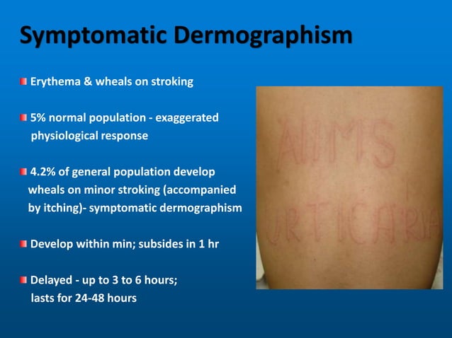 urticaria skin disease dermatology ppt.pptx