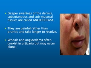 urticaria skin disease dermatology ppt.pptx