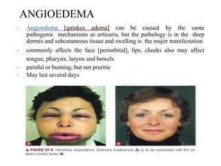 URTICARIA Symphosium final presentation.pptx