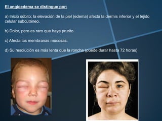 Urticaria tratamiento y fisiopatologia | PPTX