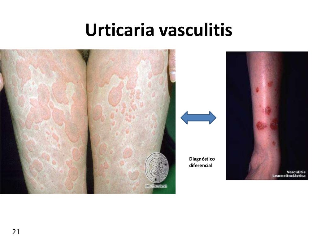 Urticaria y angioedema