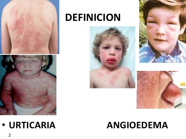 Urticaria y angioedema
