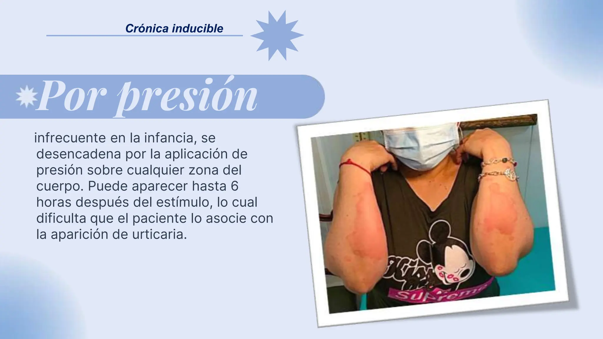 presentación urticaria y angioedema en inmunología pediátrica | PPTX