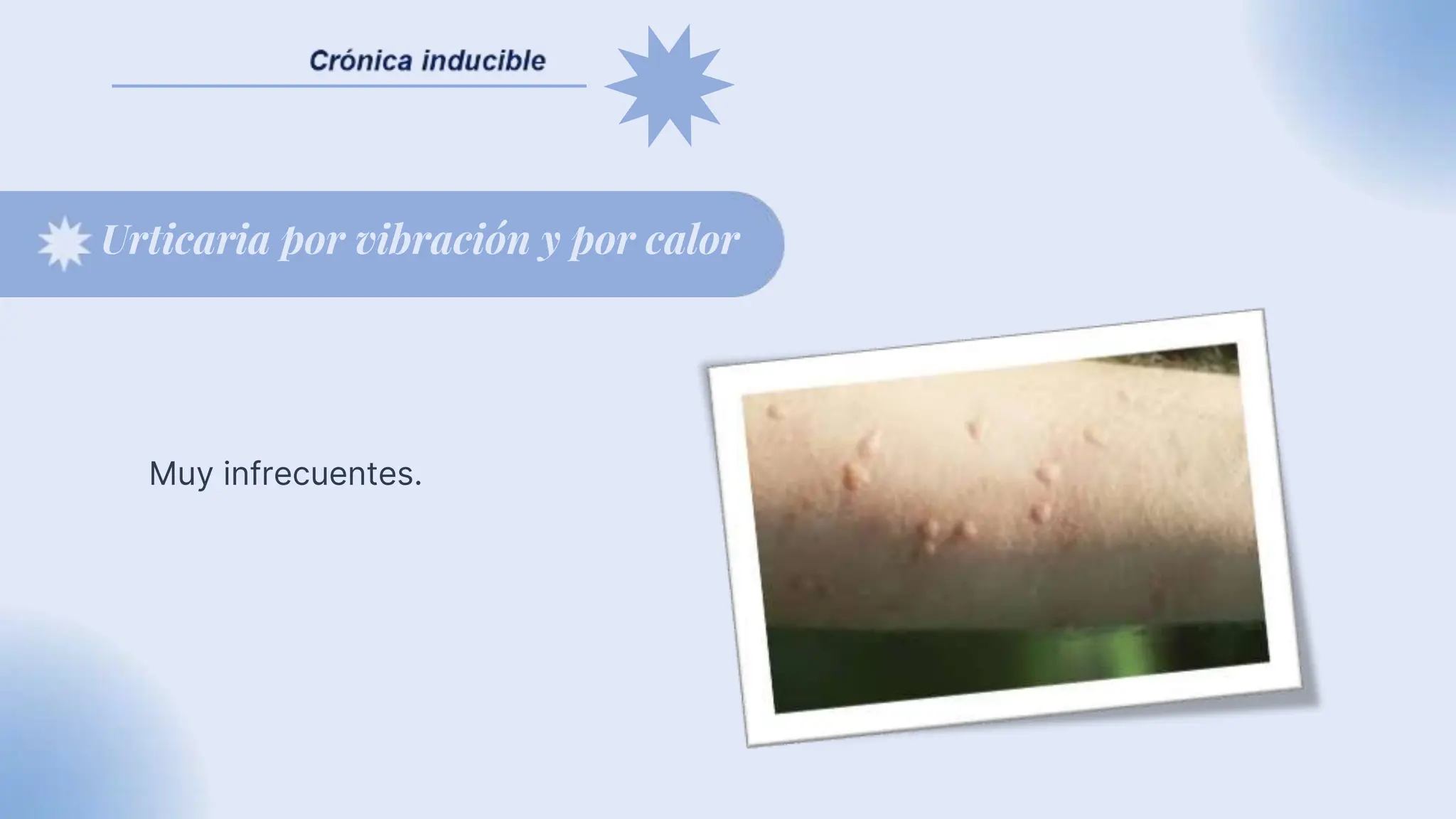 presentación urticaria y angioedema en inmunología pediátrica | PPTX