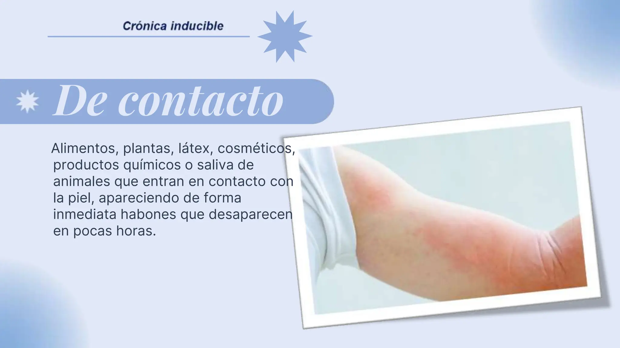 presentación urticaria y angioedema en inmunología pediátrica | PPTX