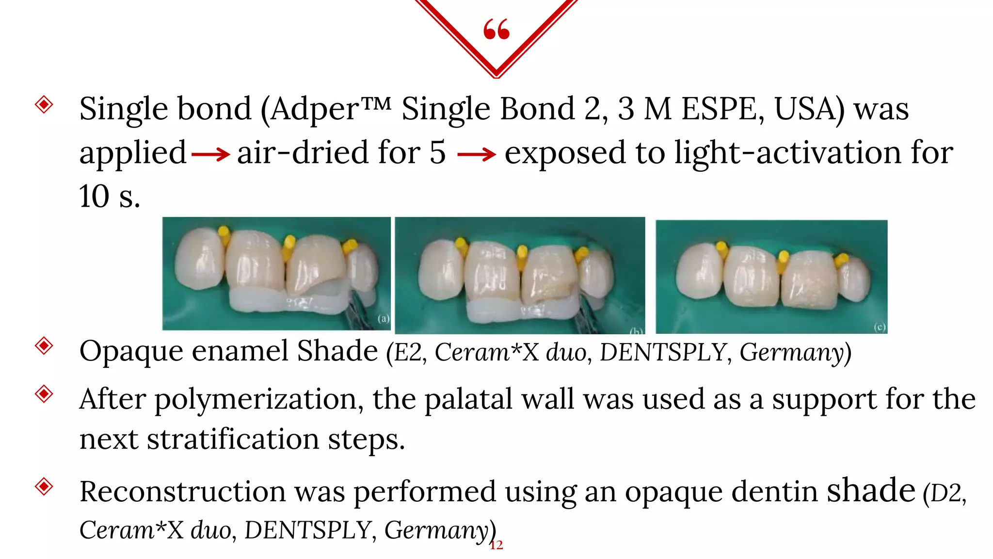 JOURNAL CLUB: “Direct resin composite restoration of maxillary central ...