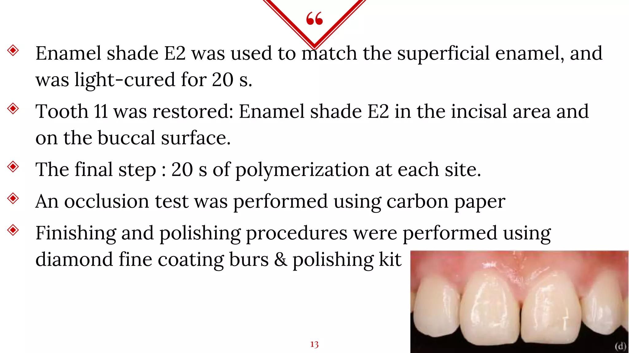 JOURNAL CLUB: “Direct resin composite restoration of maxillary central ...