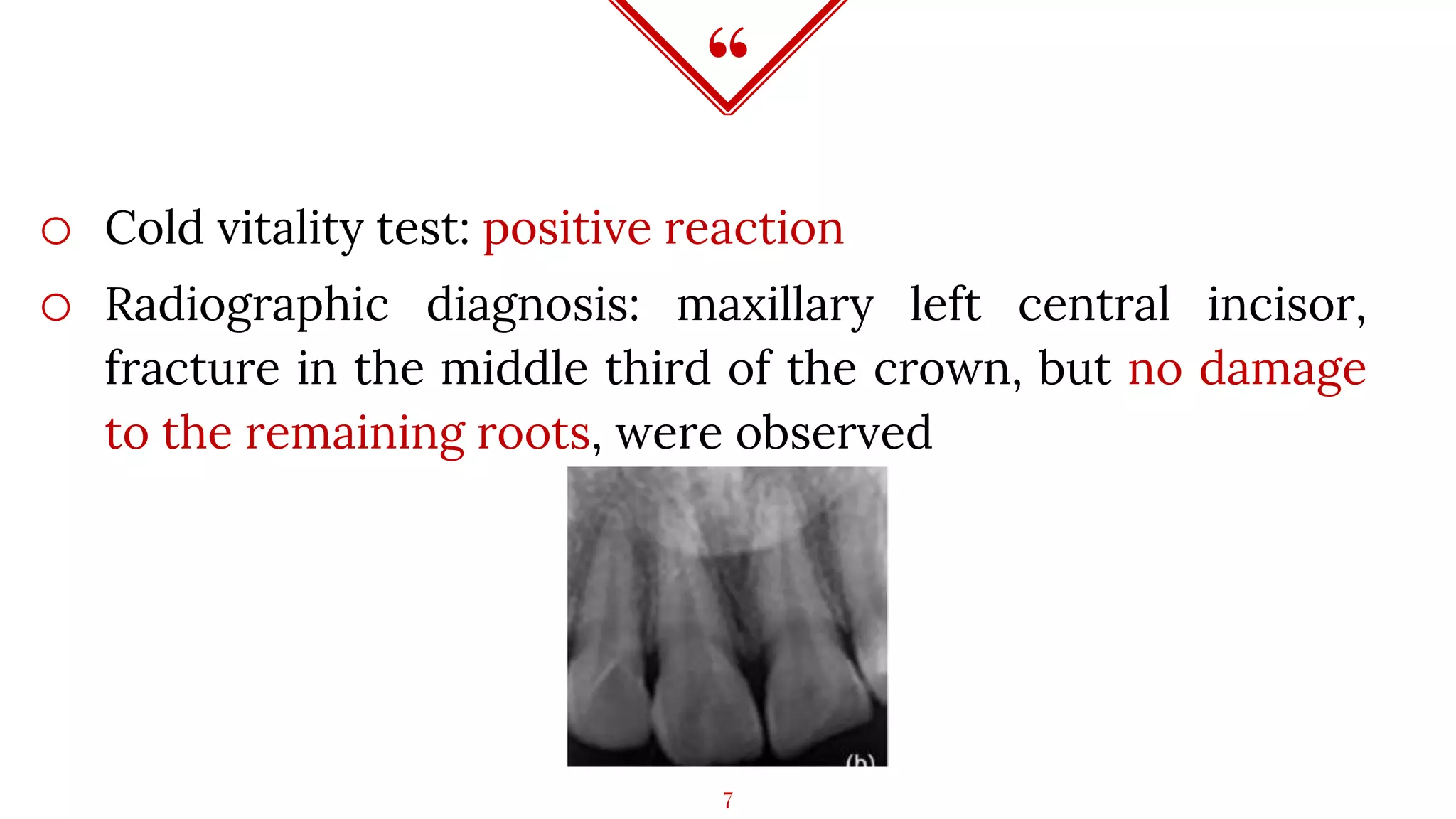 JOURNAL CLUB: “Direct resin composite restoration of maxillary central ...