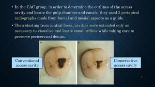 JOURNAL CLUB: Impact of Access Cavity Design and Root Canal Taper on ...