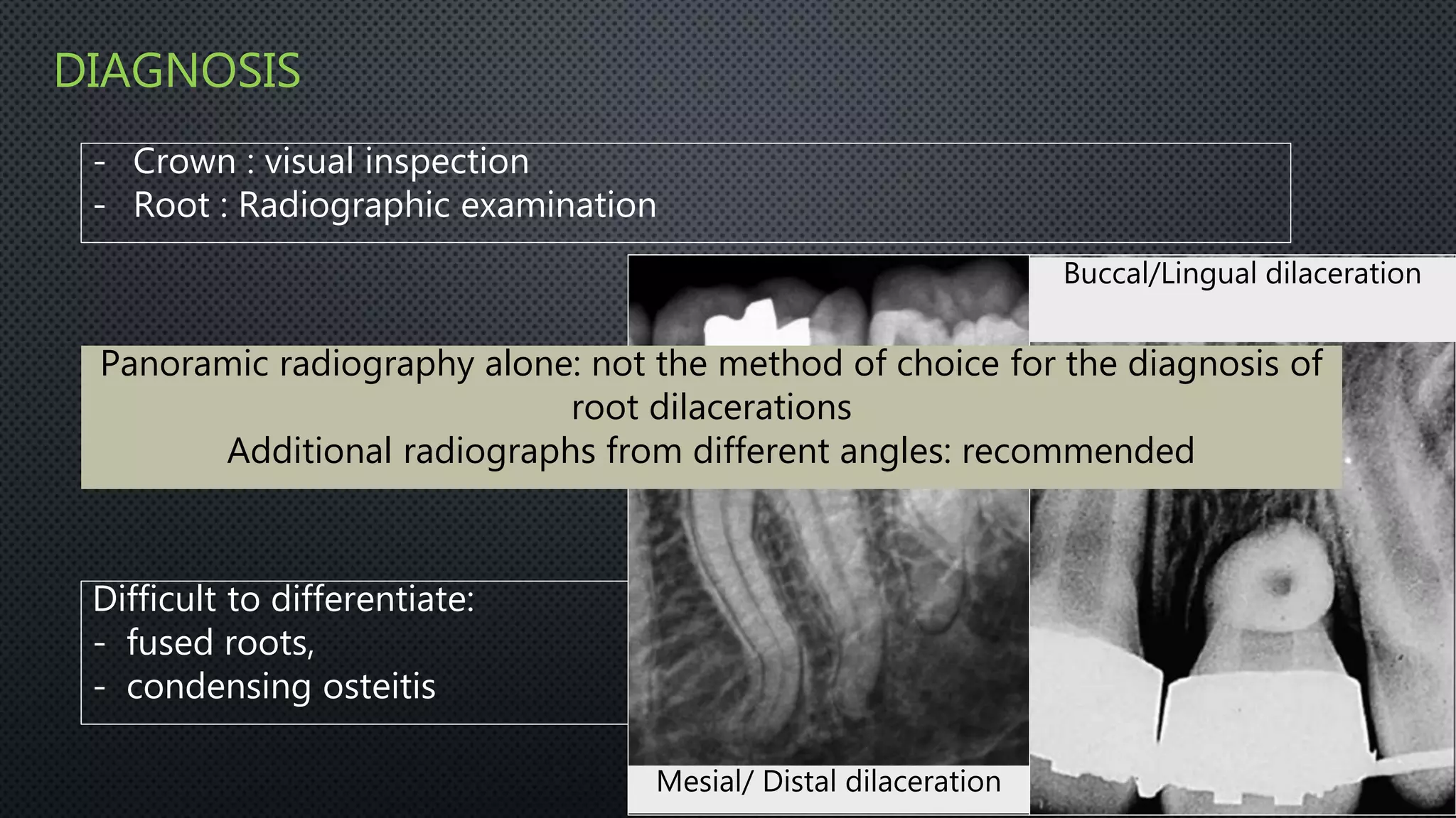 JOURNAL CLUB: Dilaceration: Review of an Endodontic Challenge | PPTX