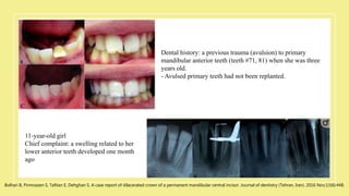 JOURNAL CLUB: Dilaceration: Review of an Endodontic Challenge | PPTX
