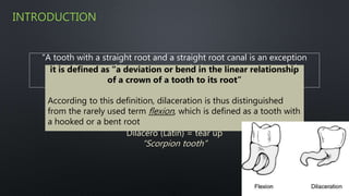 JOURNAL CLUB: Dilaceration: Review of an Endodontic Challenge | PPTX