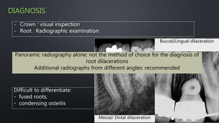 JOURNAL CLUB: Dilaceration: Review of an Endodontic Challenge | PPTX