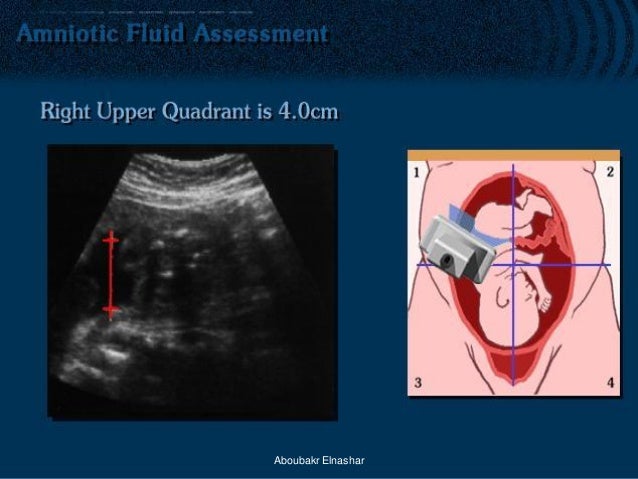 ultrasonography of amniotic fluid